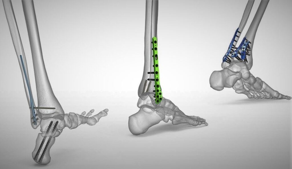 Orthopedic Implants Manufacturer, Supplier & Exporter | HCM Orthocare